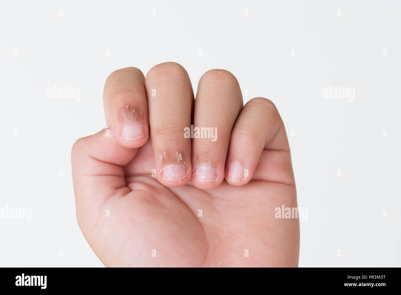 Close up child's fingers with dry skin, Eczema Dermatitis. Medicine and ...