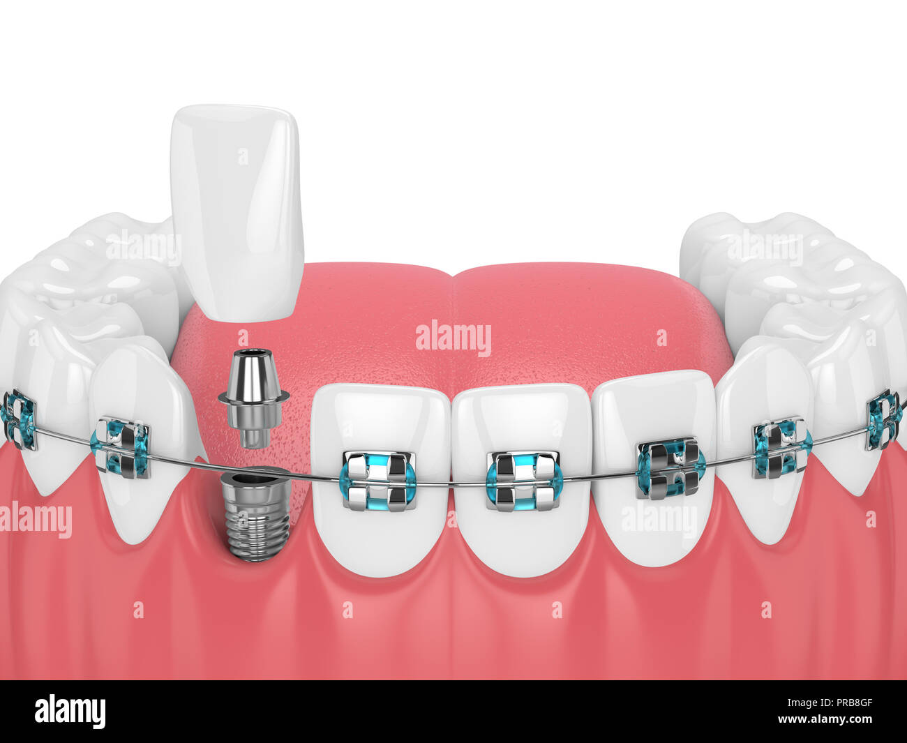 3d render of teeth with orthodontic braces and dental implant ...