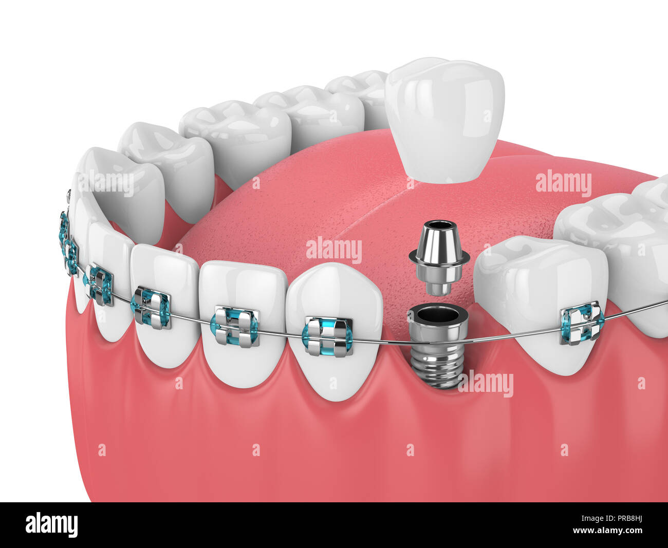 3d render of teeth with orthodontic braces and dental implants ...