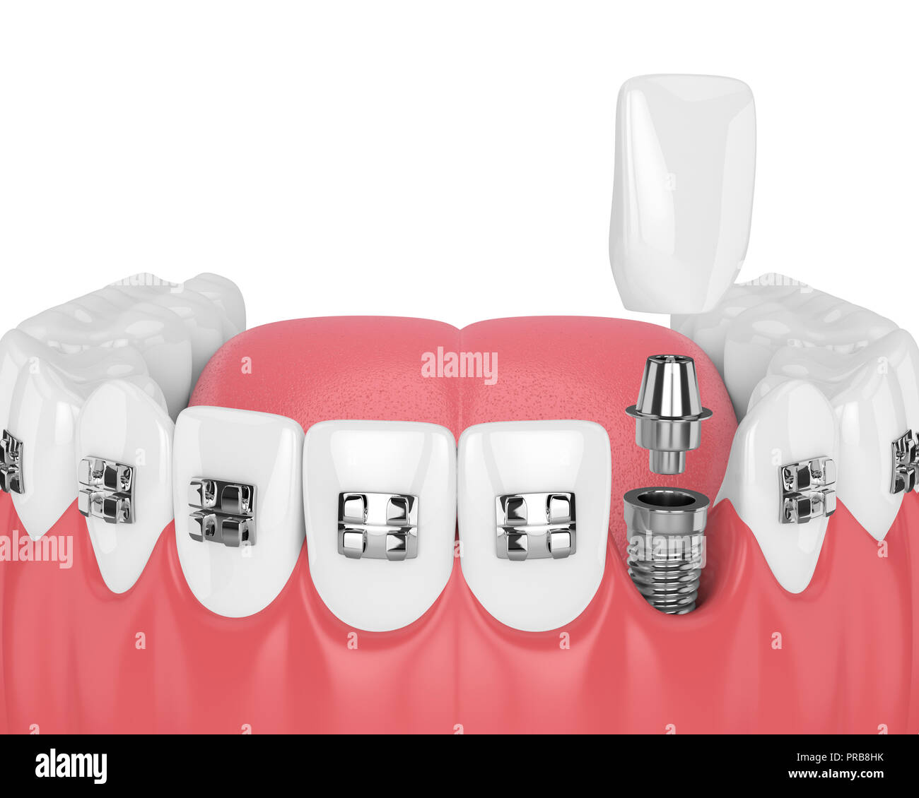 3d render of teeth with orthodontic braces and dental implant ...
