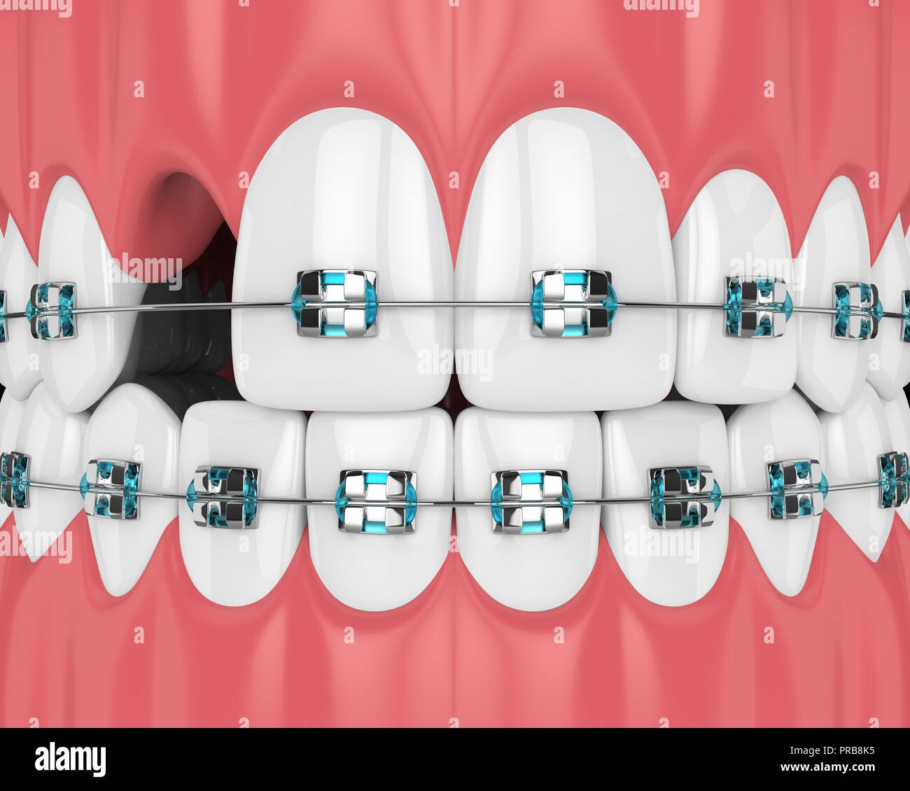 3d render of teeth with braces and cavity. Dental treatment concept ...