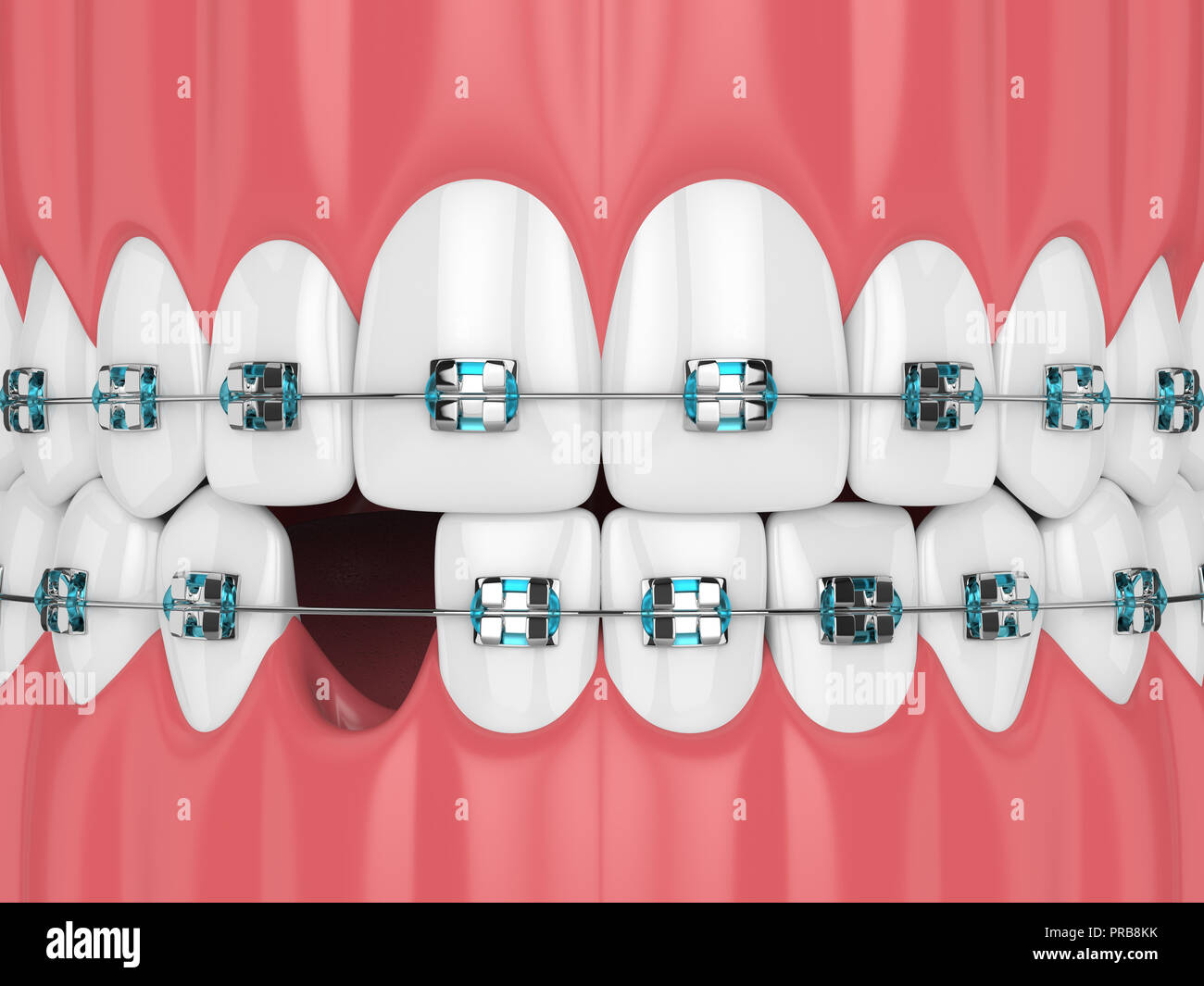 3d render of teeth with braces and cavity isolated over white ...