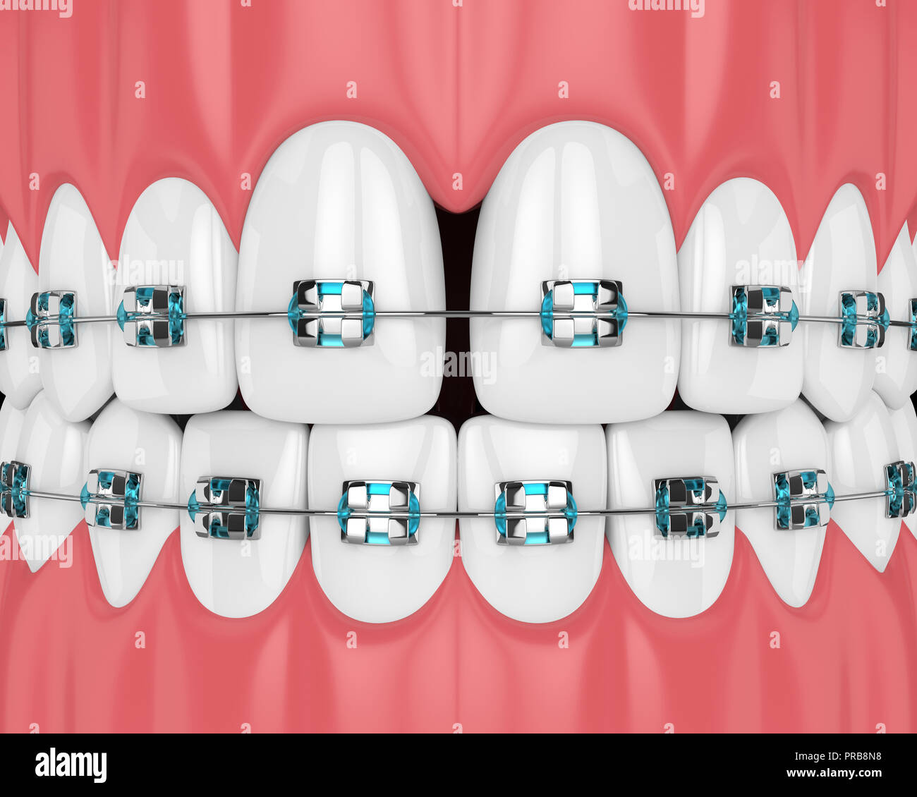 3d render of teeth with diastema and braces. Diastema correction ...