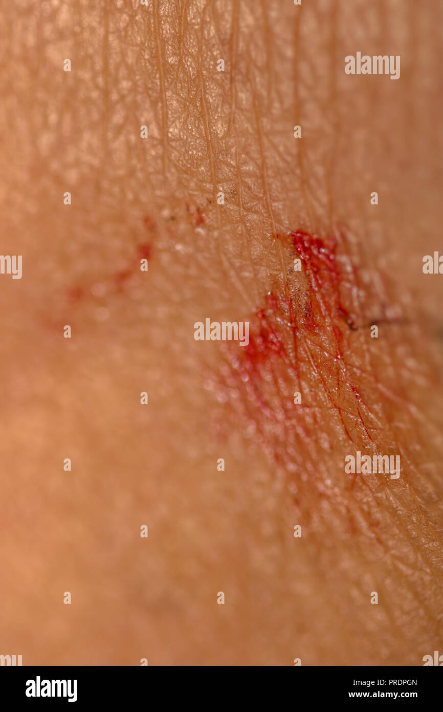 Blood scratch hi-res stock photography and images - Alamy