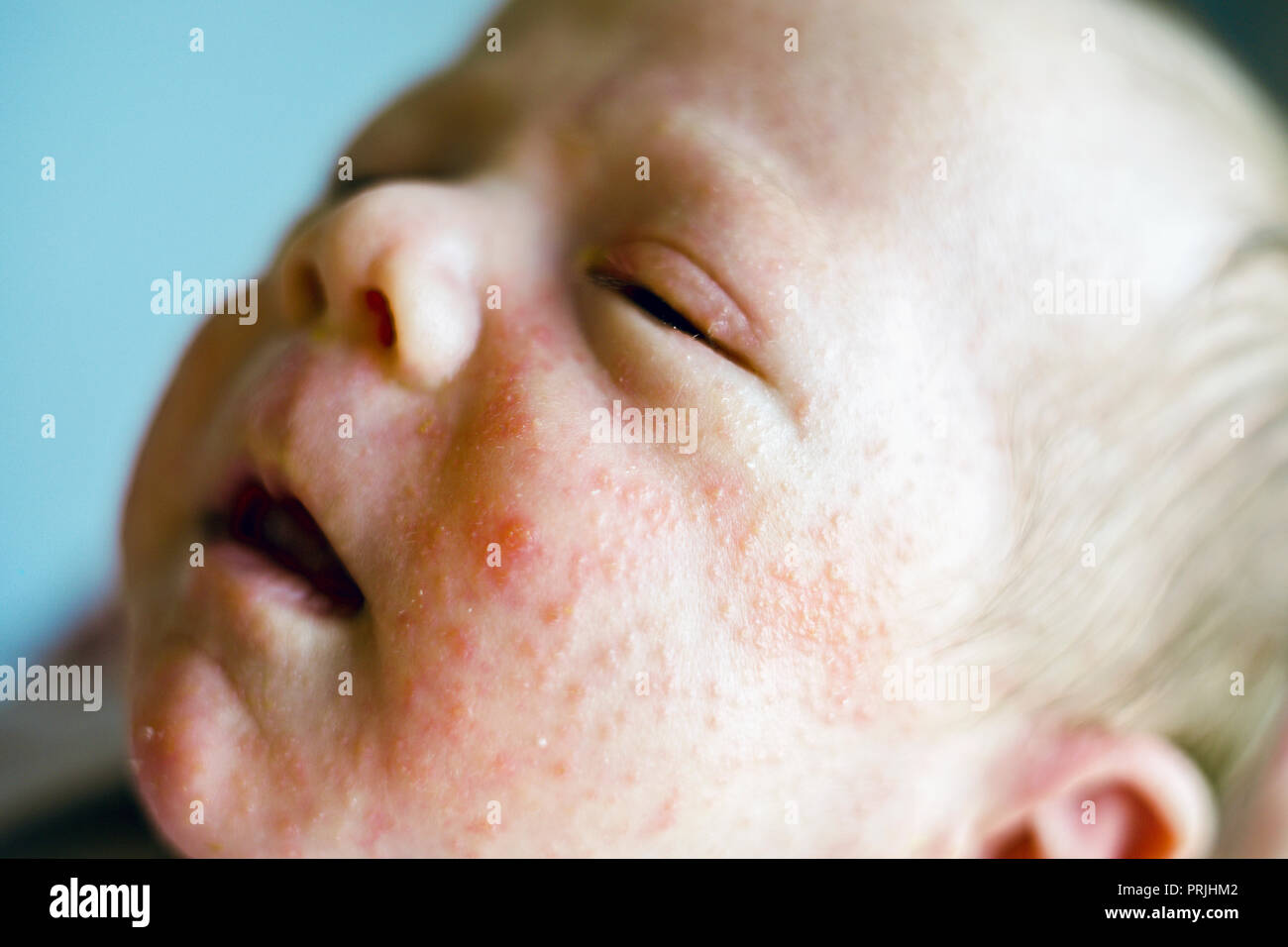 Atopic child hi-res stock photography and images - Alamy