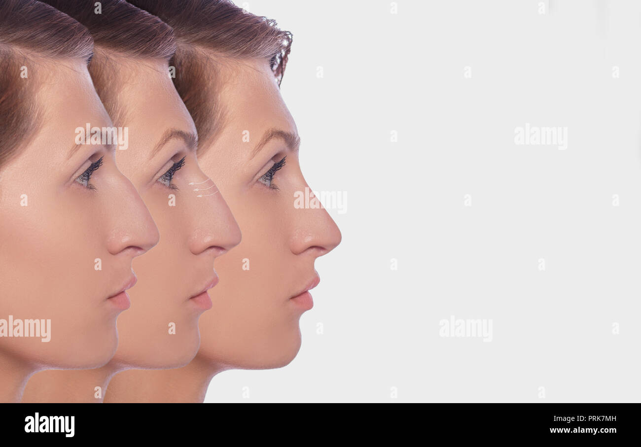 profile female before and after plastic surgery on her nose Stock Photo ...
