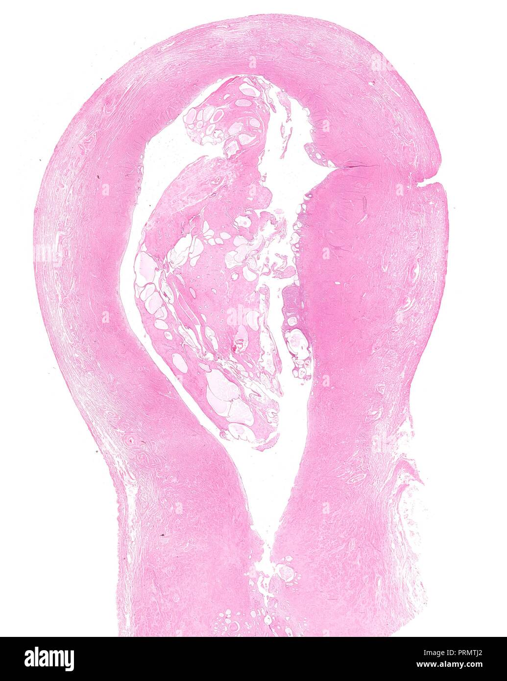 Matronenpolyp hi-res stock photography and images - Alamy