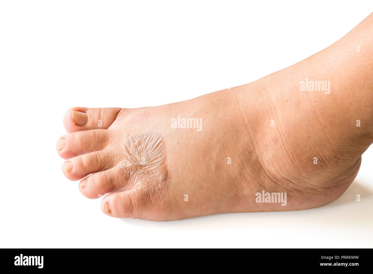 Scald hi-res stock photography and images - Alamy