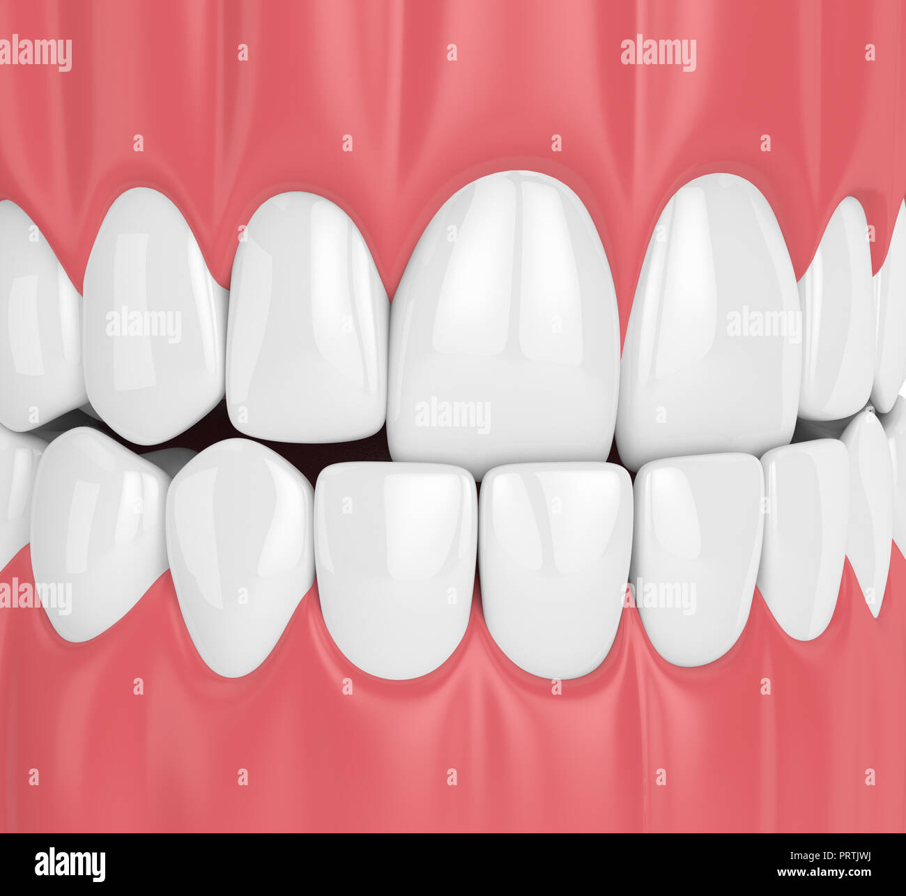 3d render of jaw malocclusion with underbite. Upper teeth behind lower ...