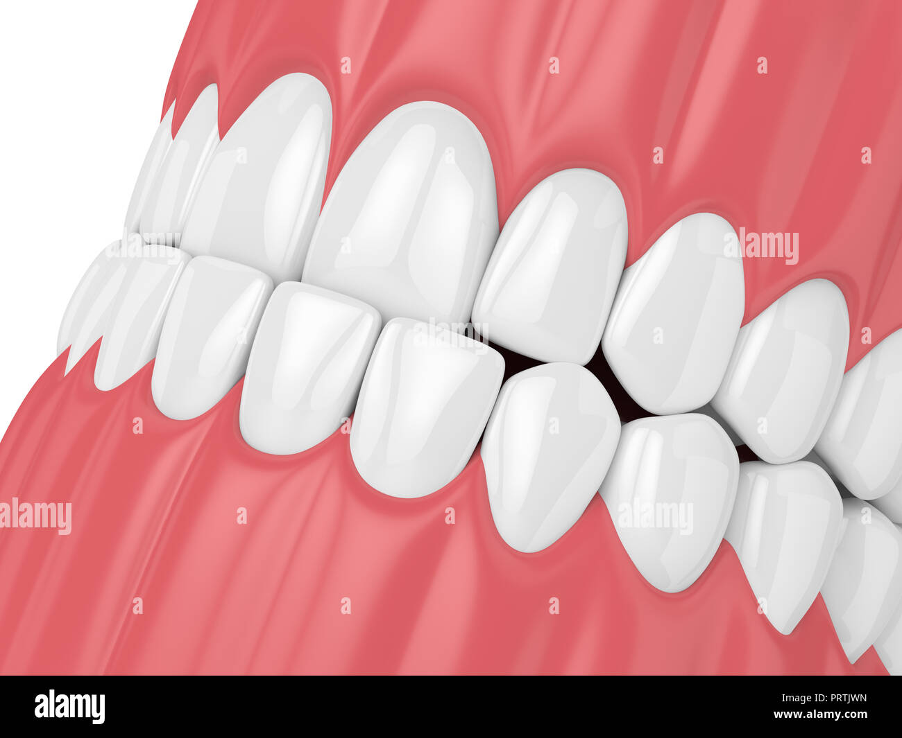 3d render of jaw malocclusion with underbite. Upper teeth behind lower ...