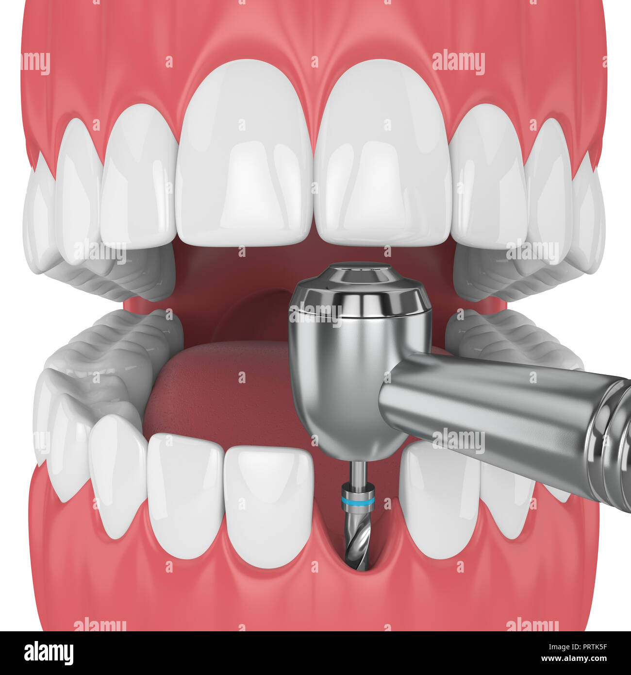 3d render of jaw with dental implant drill. Implantation process ...