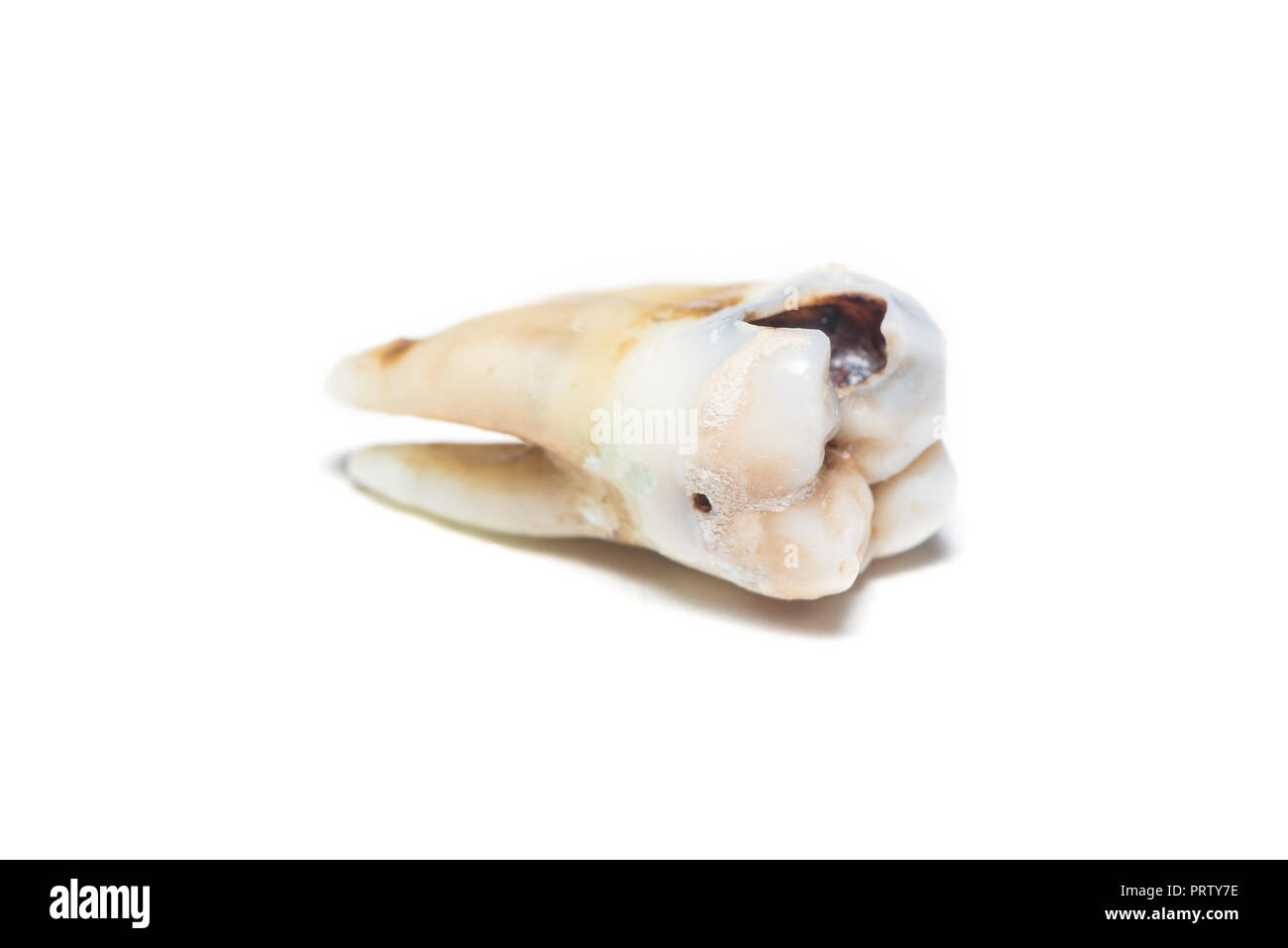 A tooth decay in perspective view isolated on white background Stock ...