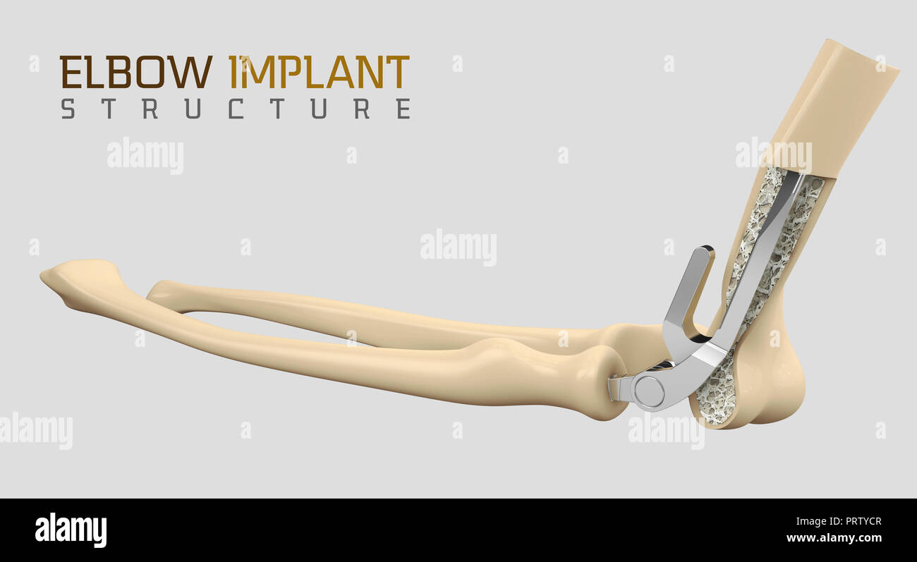 3d illustration of the endoprosthesis of the elbow joint Stock Photo ...