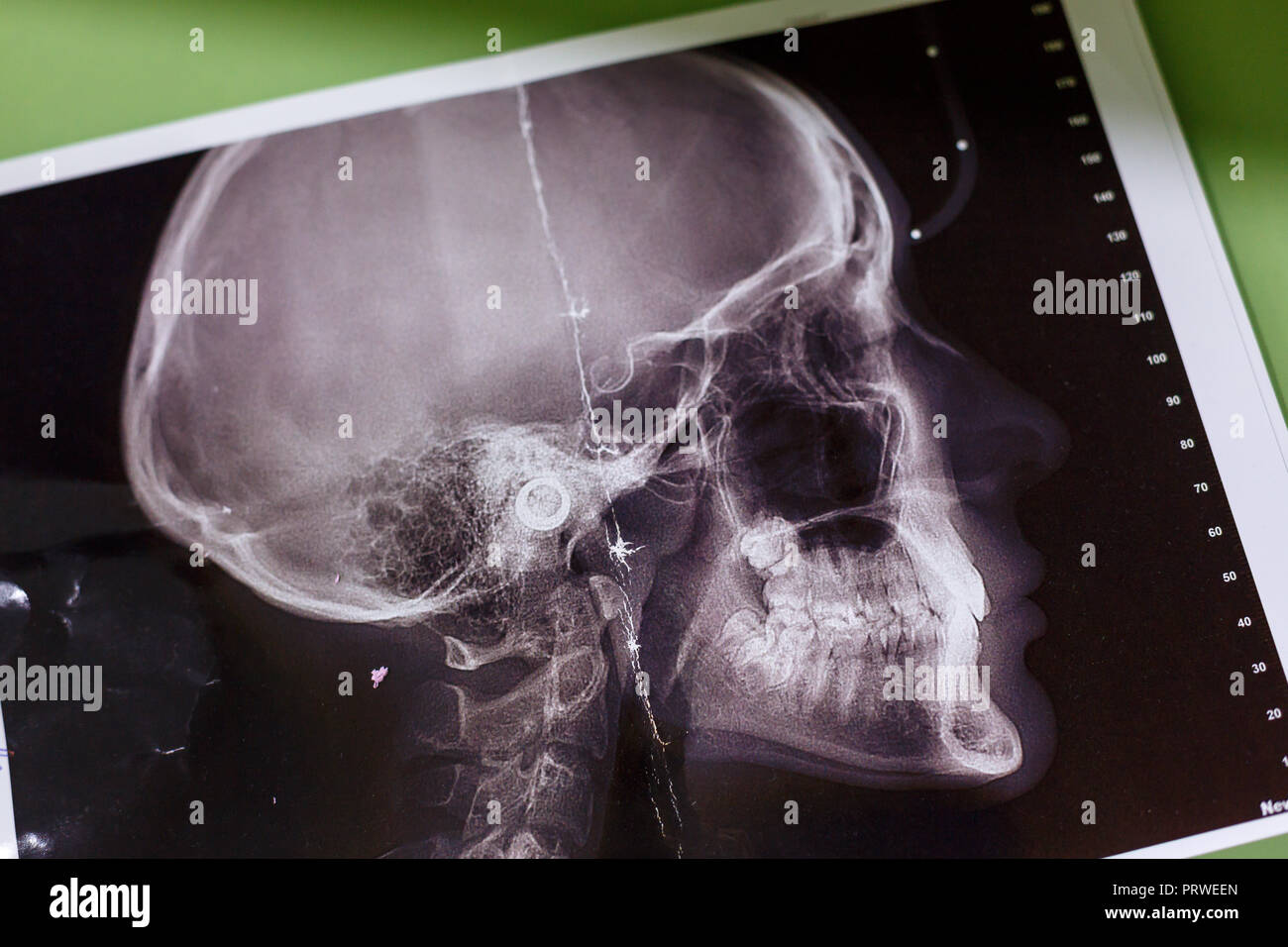 Lateral X Ray Cervical Spine Neck Stock Photos & Lateral X Ray Cervical ...