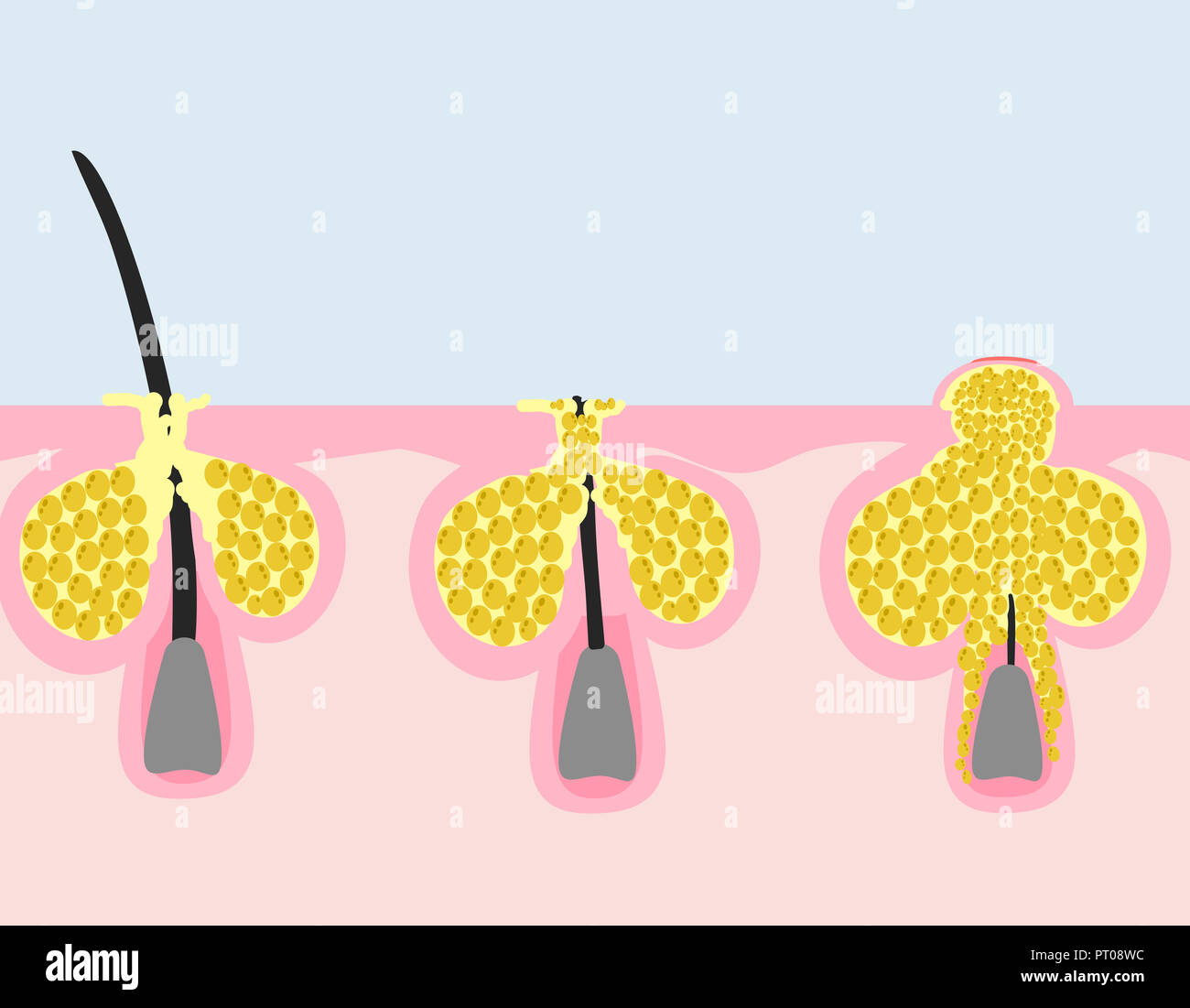 Acne vulgaris hi-res stock photography and images - Alamy