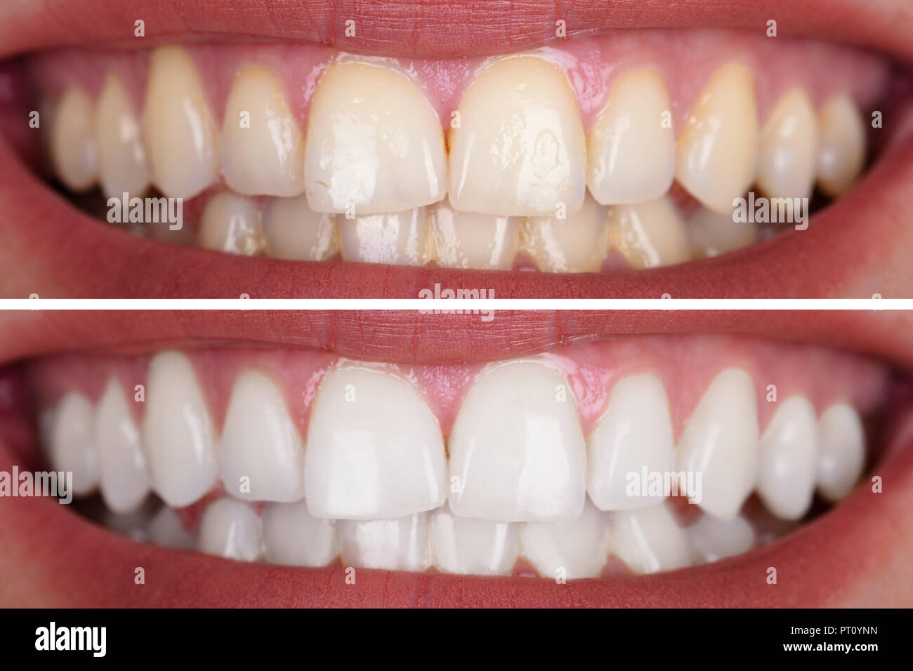 Skin bleaching before after hi-res stock photography and images - Alamy