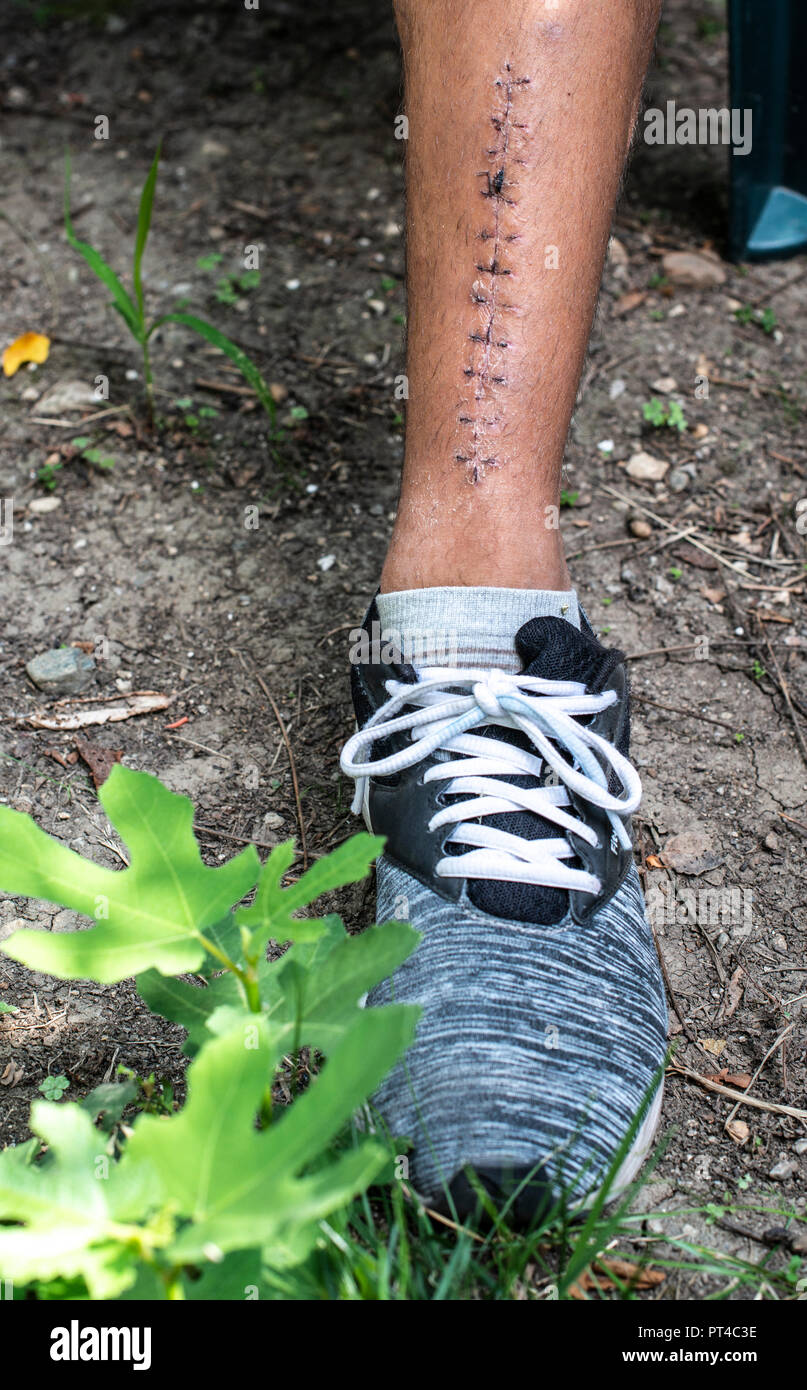 Closeup wound surgical stitch hi-res stock photography and images - Alamy