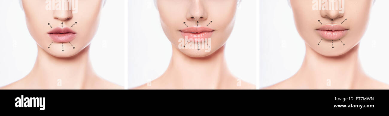 set perfect shape lips with arrows showing idea of lip augmentation ...