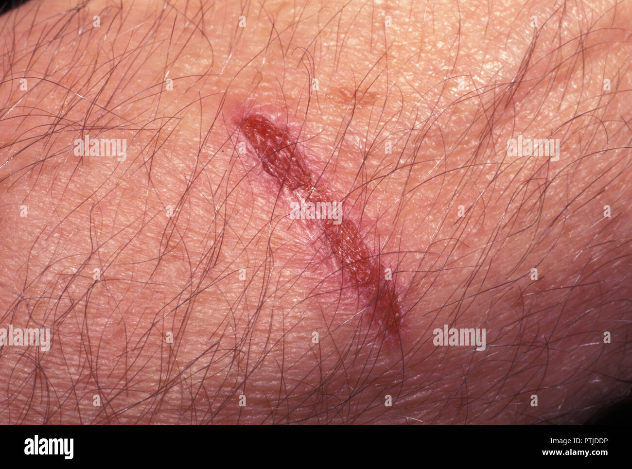 Small wound hi-res stock photography and images - Alamy