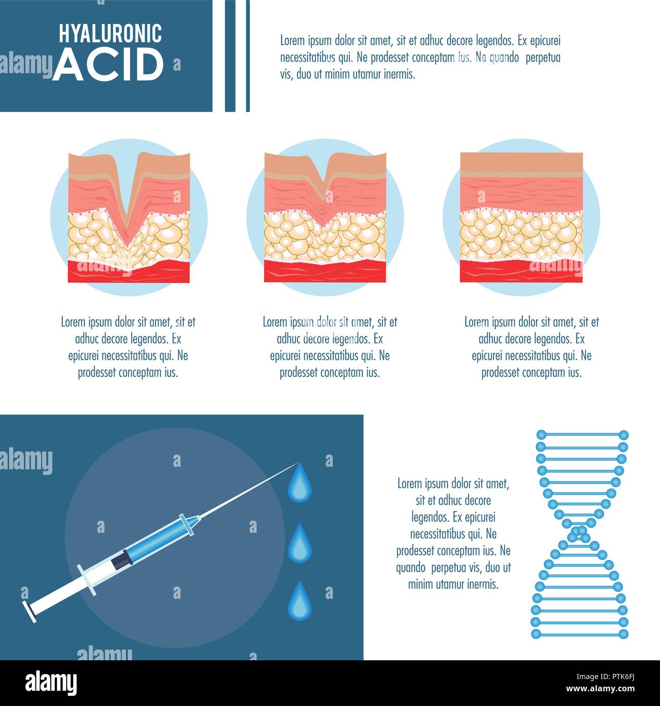 hyaluronic acid filler injection infographic Stock Vector Image & Art ...