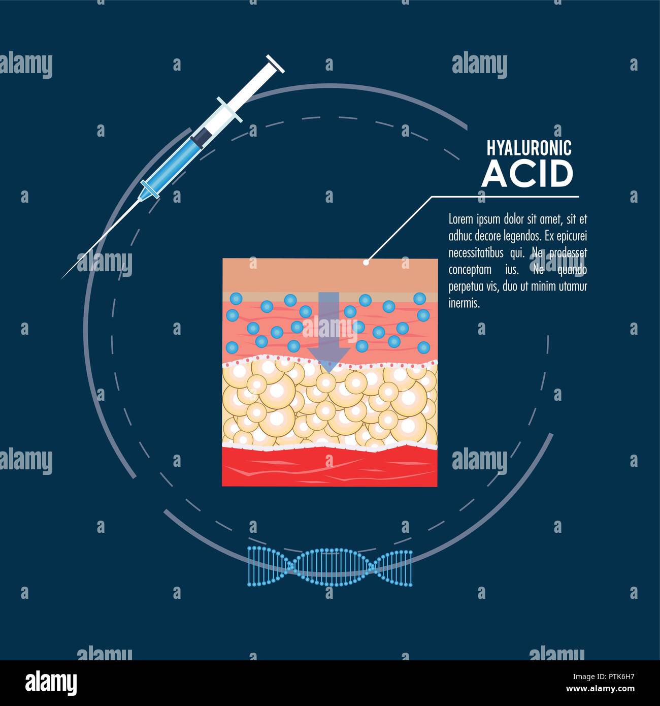 hyaluronic acid filler injection infographic Stock Vector Image & Art ...