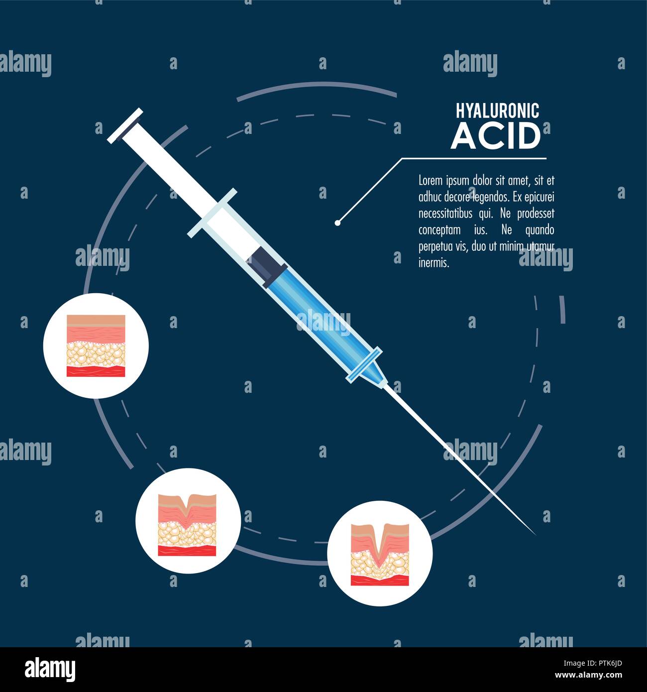hyaluronic acid filler injection infographic Stock Vector Image & Art ...
