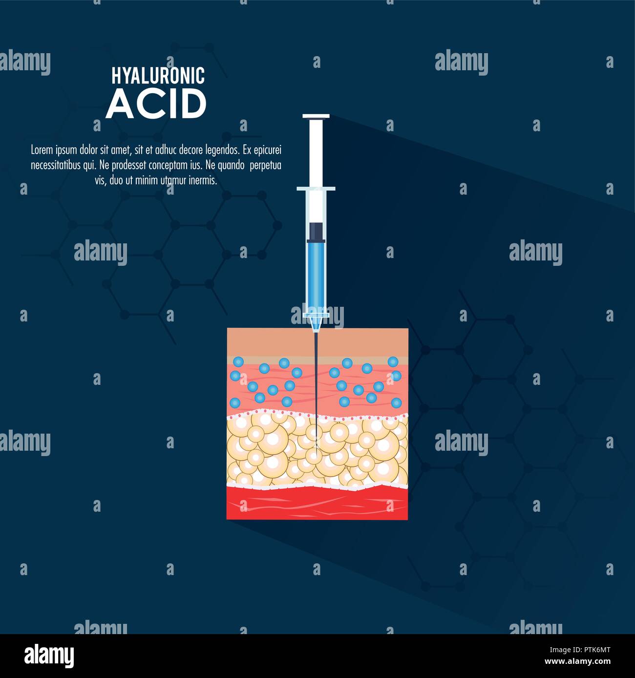 hyaluronic acid filler injection infographic Stock Vector Image & Art ...