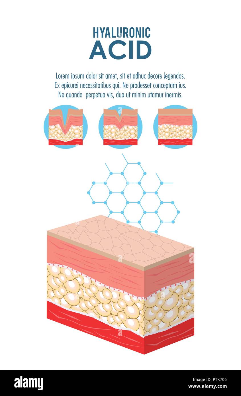 hyaluronic acid filler injection infographic Stock Vector Image & Art ...