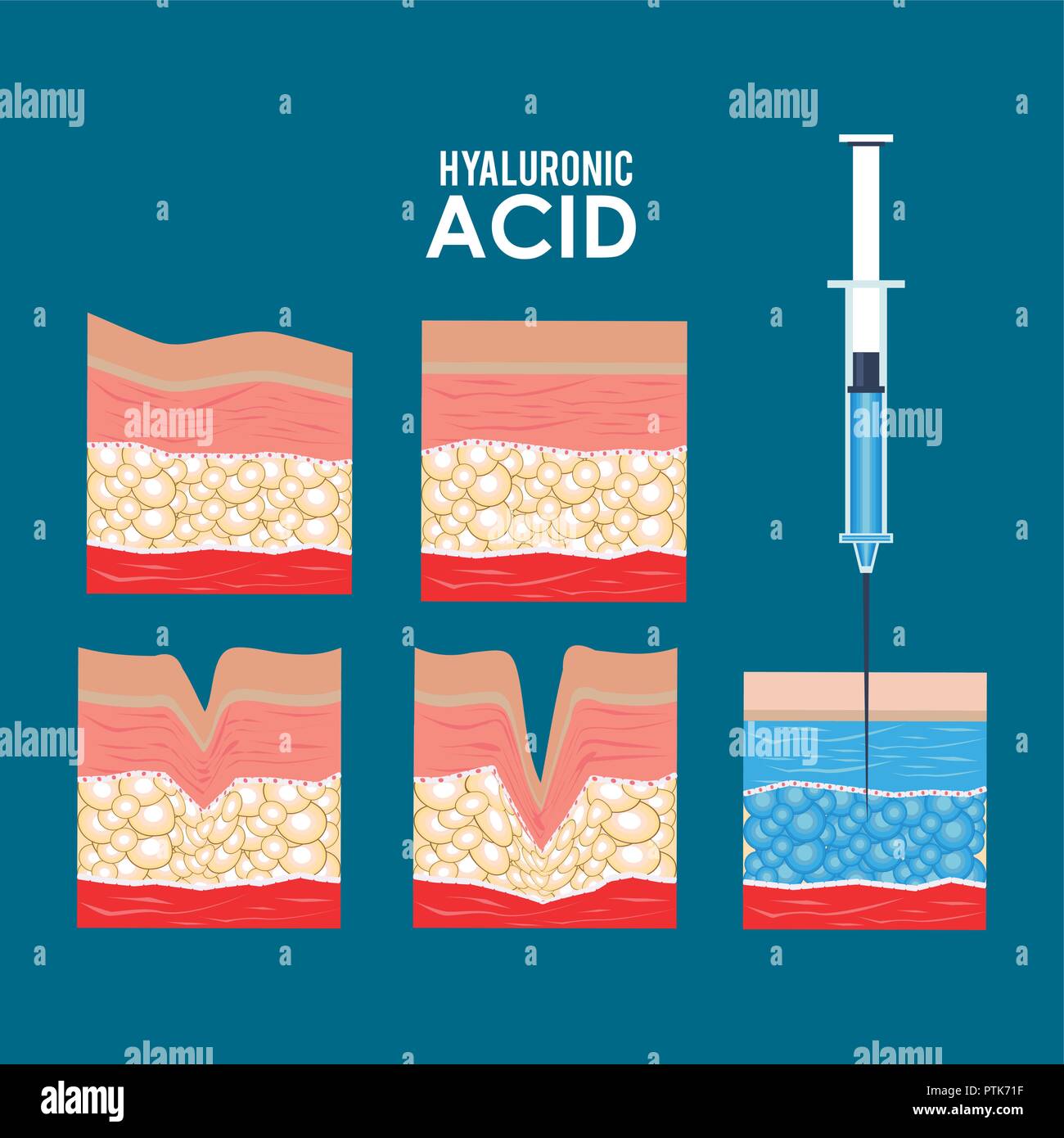 hyaluronic acid filler injection infographic Stock Vector Image & Art ...