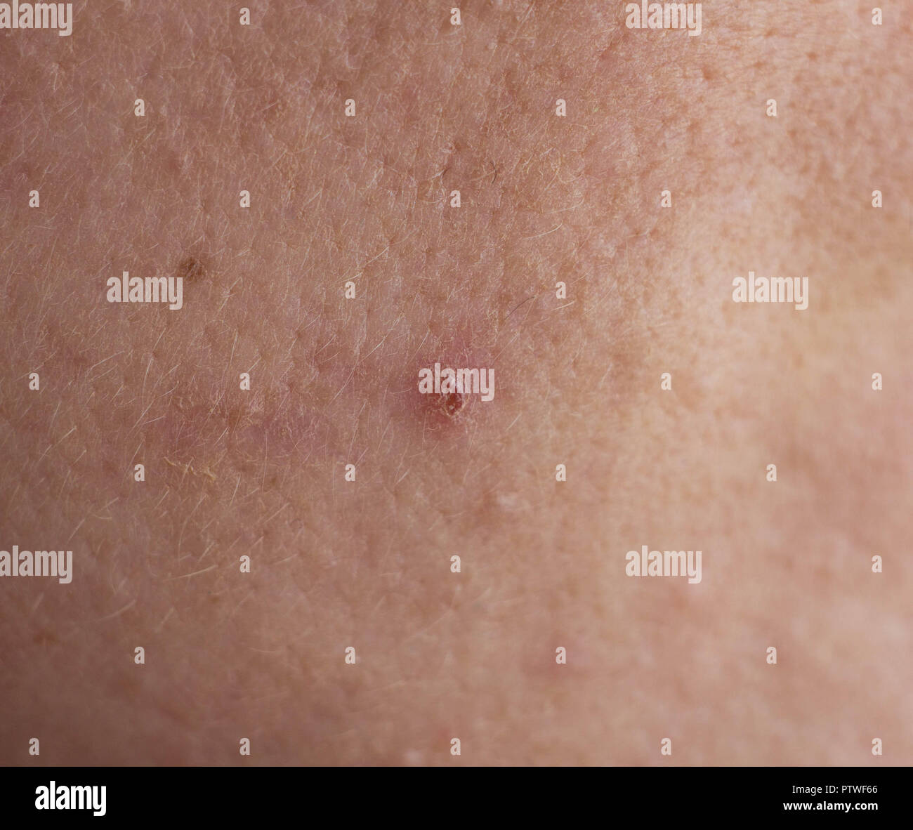Red pimple on face macro, abscess and acne Stock Photo - Alamy