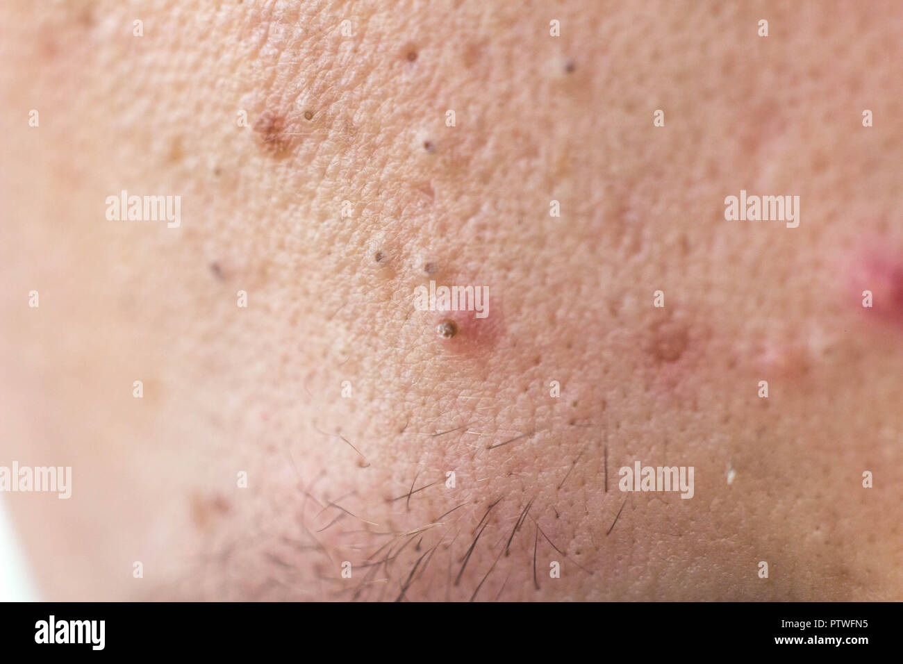 White comedo hi-res stock photography and images - Alamy