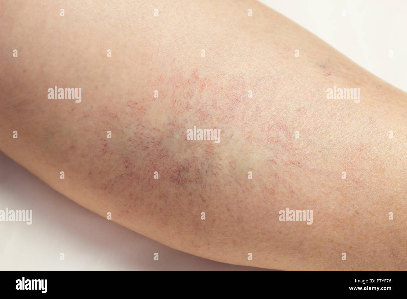 Chronic varicose eczema hi-res stock photography and images - Alamy