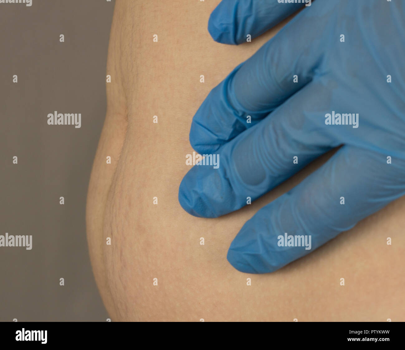 Stretch Marks Stock Photos & Stretch Marks Stock Images - Alamy