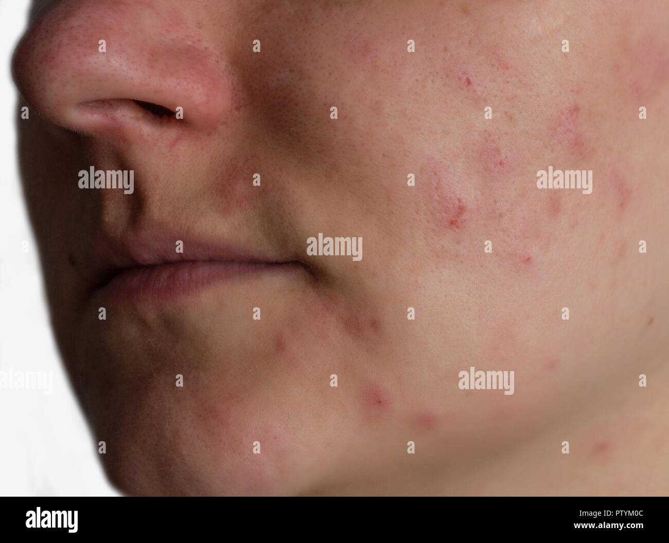 Acne bacteria hi-res stock photography and images - Alamy