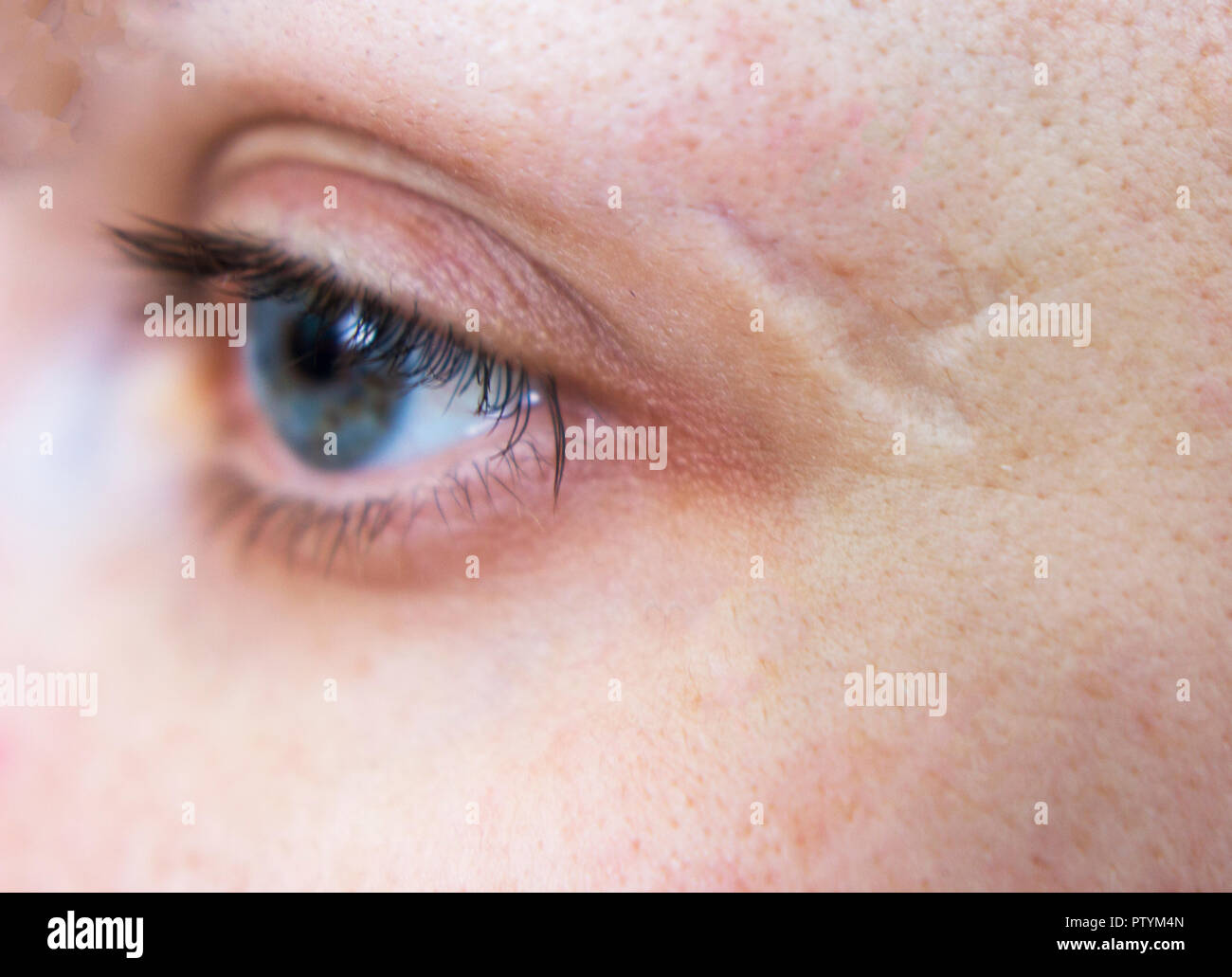 Bruised eye girl hi-res stock photography and images - Alamy