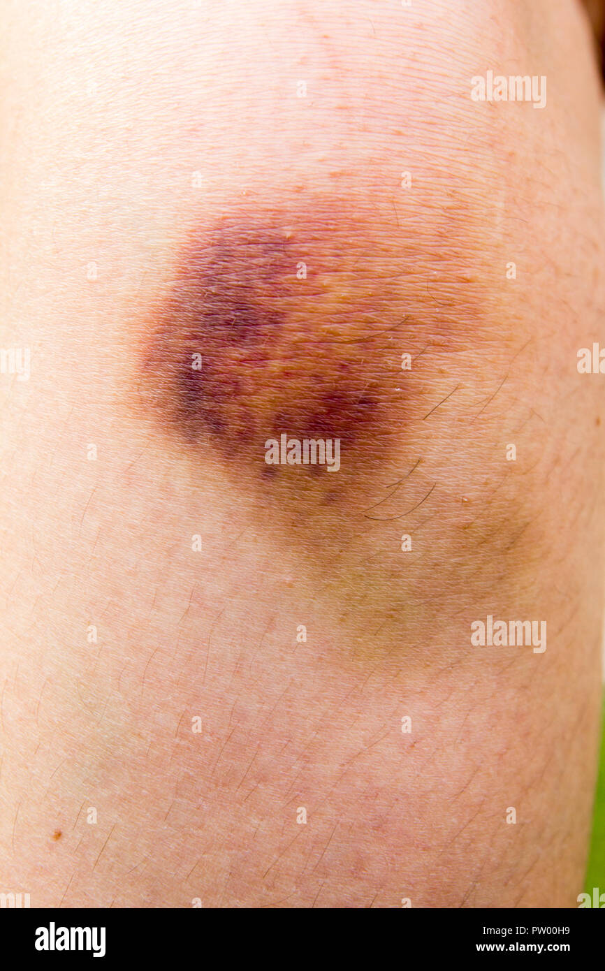 Brown bruise on woman knee background Stock Photo - Alamy