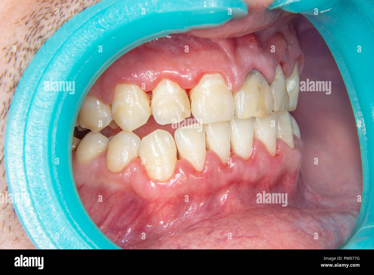 Cleaning an abscess hi-res stock photography and images - Alamy