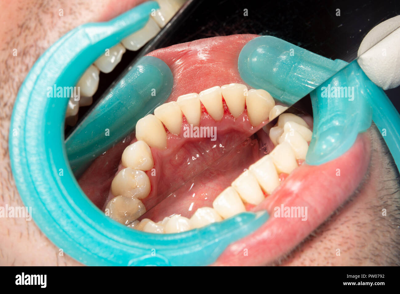 Close-up of a person's teeth after removing and cleaning a plaque in a ...