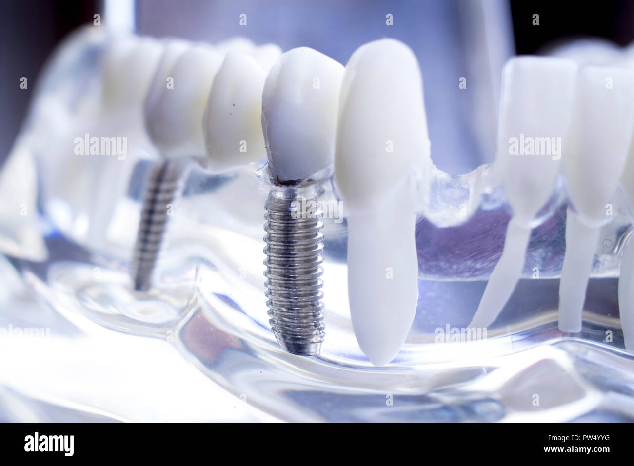 Dentist dental teeth teaching model showing titanium metal tooth ...