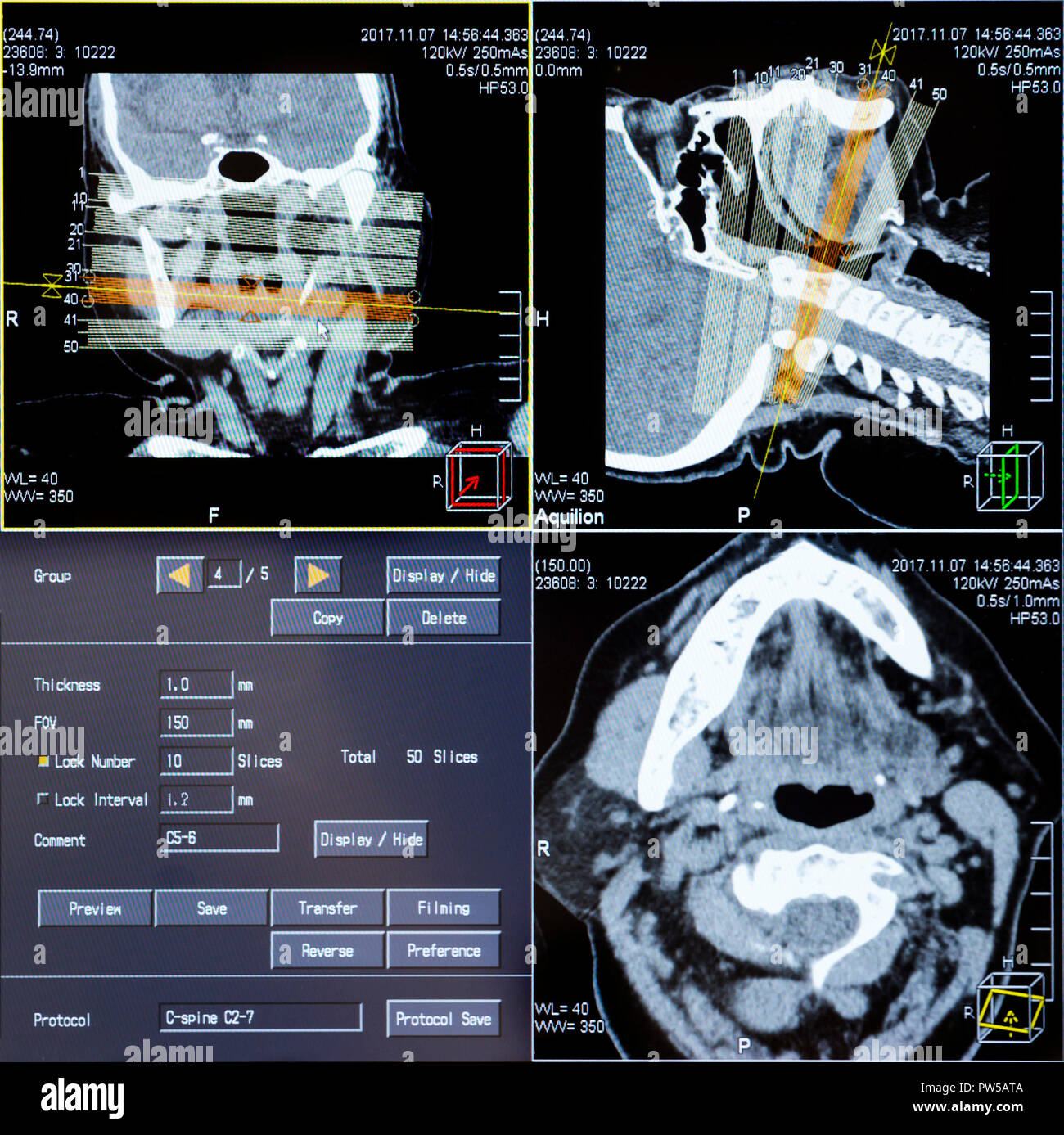 Magnetic resonance imaging (MRI) scan - CT scans of human head on a ...