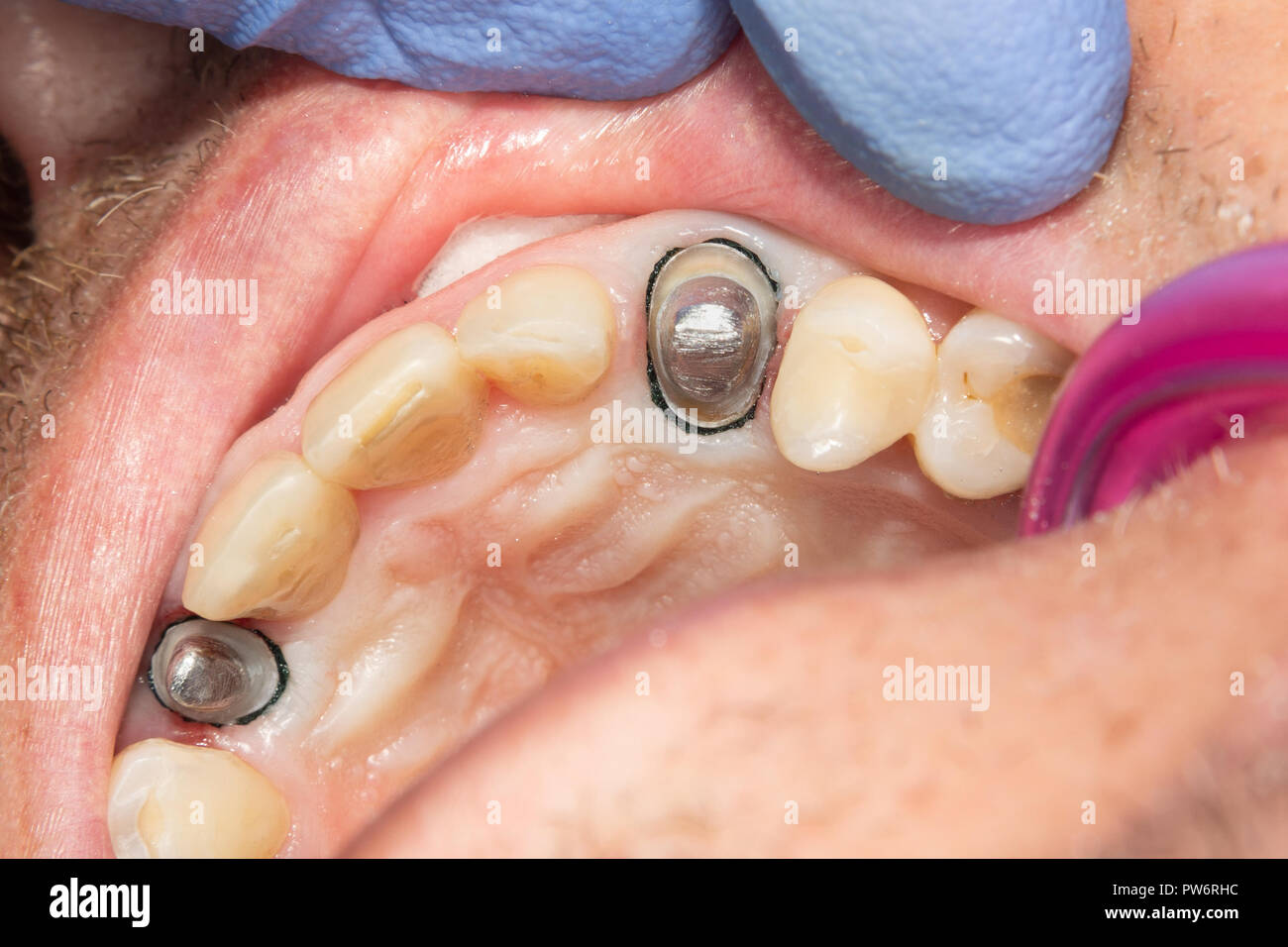 close-up human tooth together with a pin, is prepared by a bur under ...