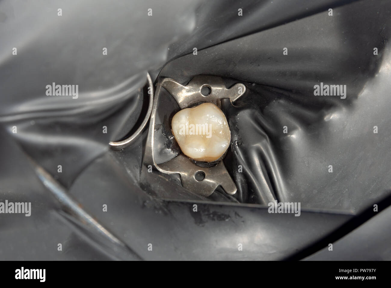two chewing side teeth of the upper jaw after treatment of caries ...