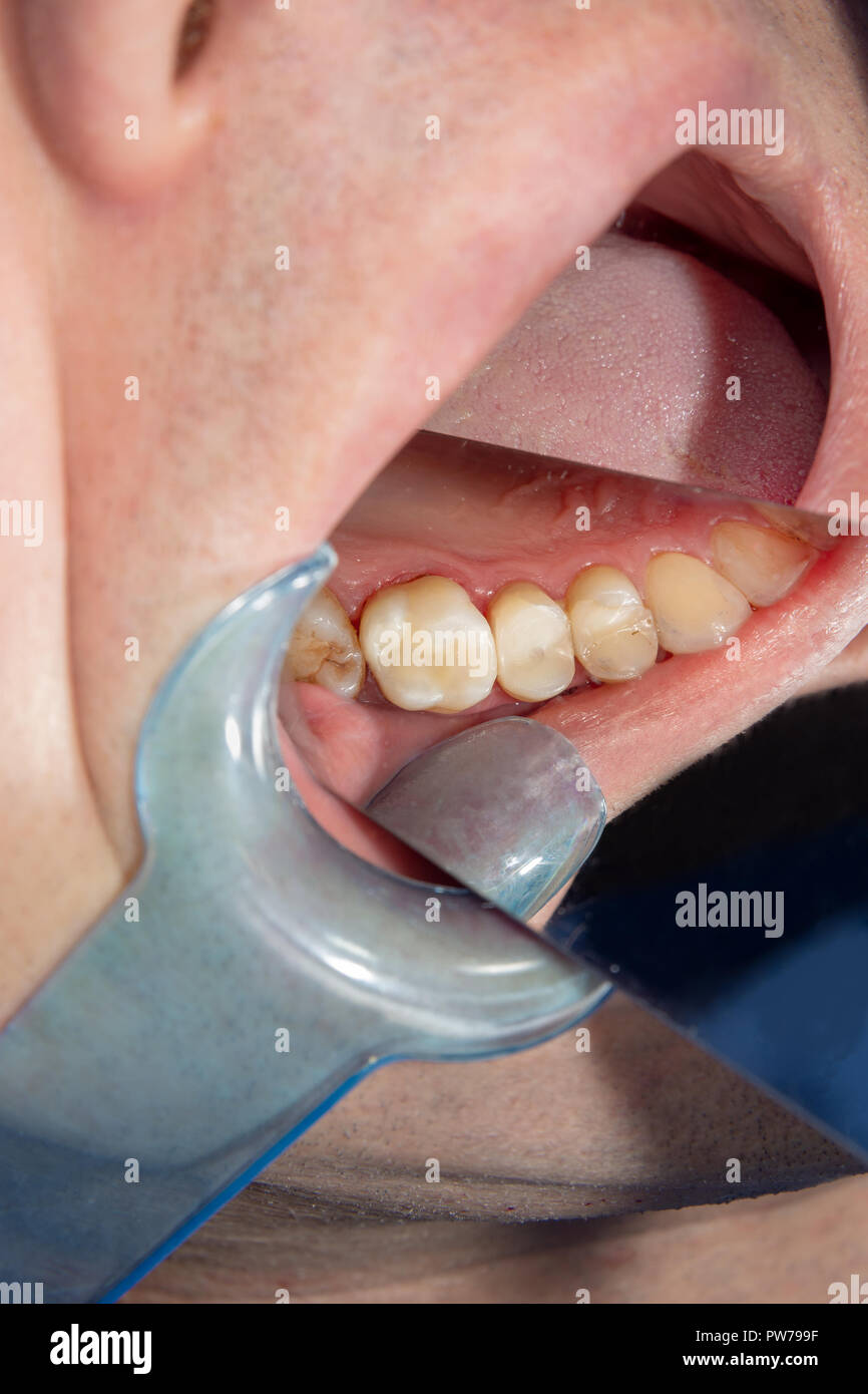 two chewing side teeth of the upper jaw after treatment of caries ...