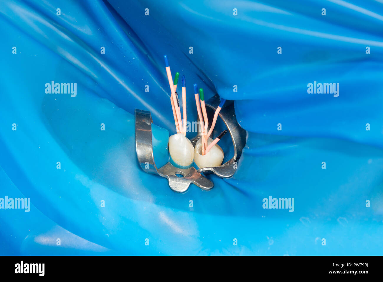 photo endodontic treatment of dental canals in the lower molar ...