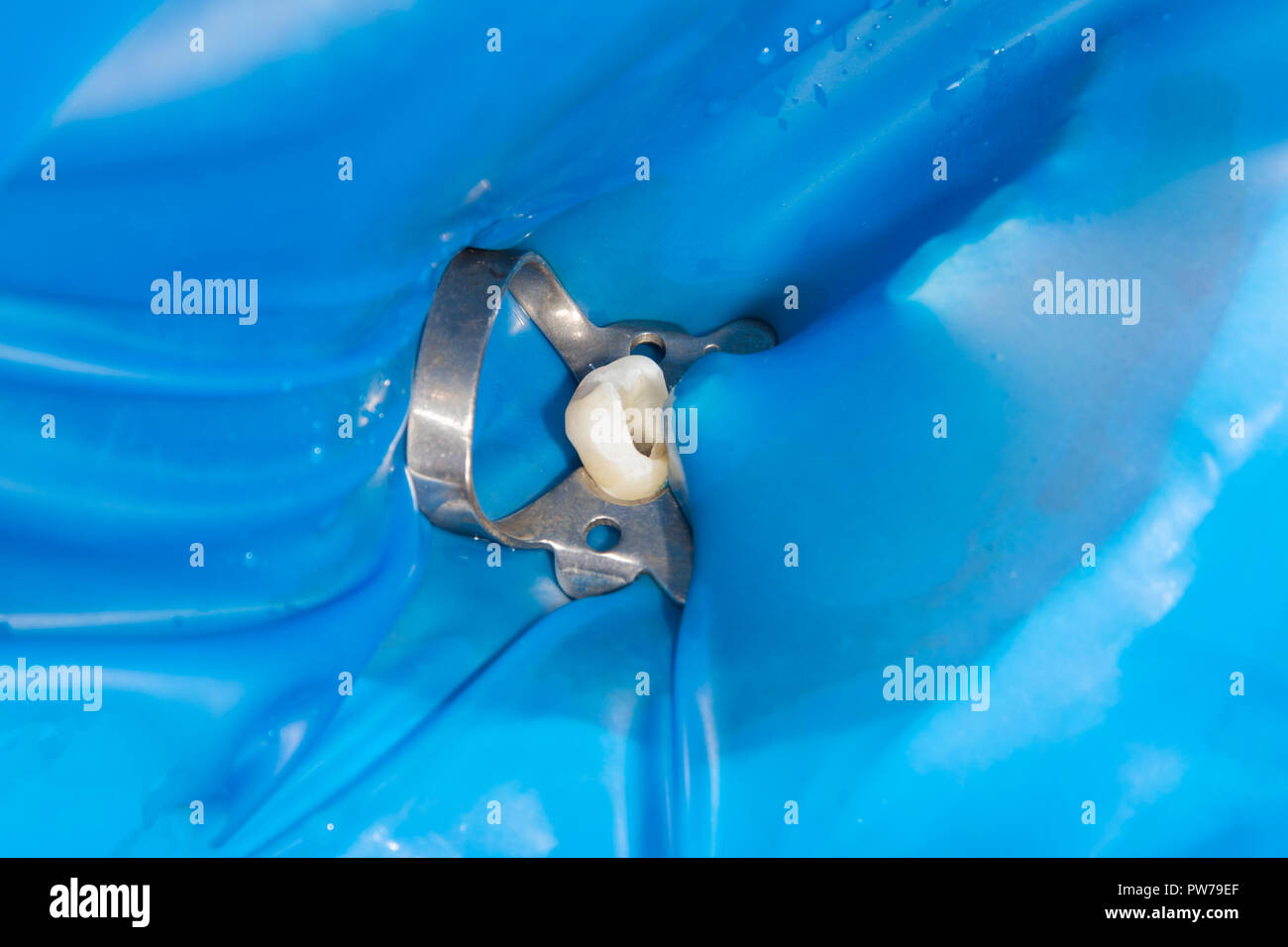 photo endodontic treatment of dental canals in the lower molar ...