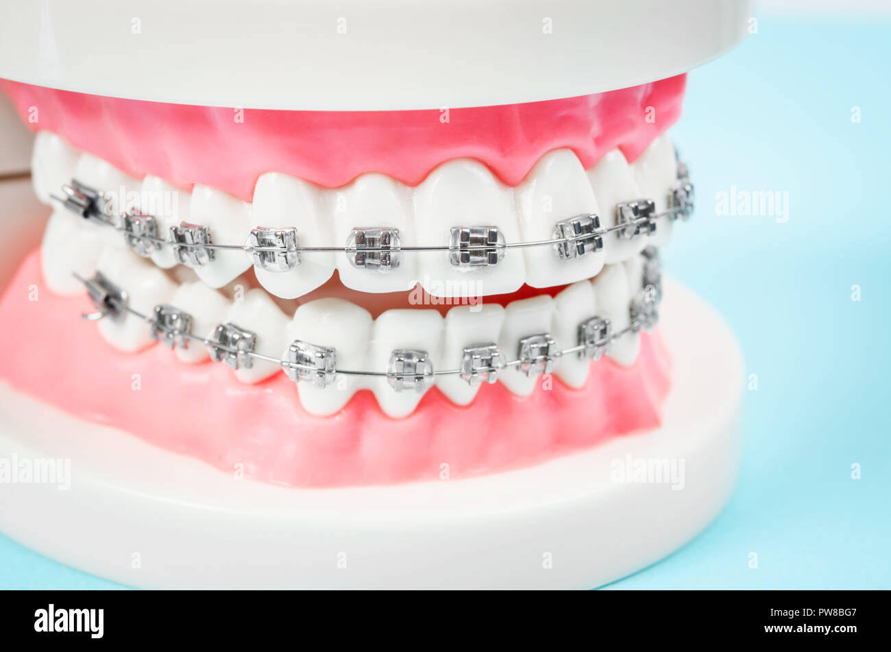 tooth model with metal wire dental braces on blue background Stock ...