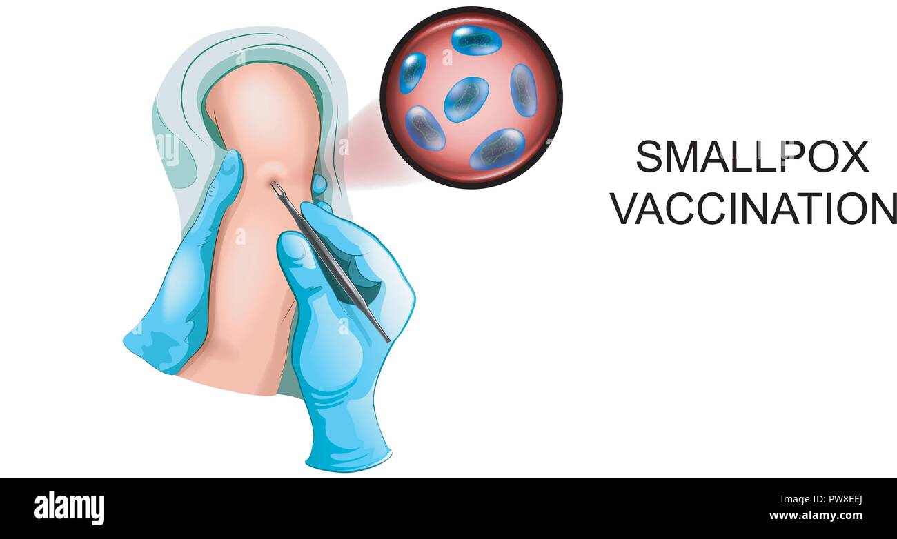 vector illustration of vaccination of a child against smallpox Stock ...