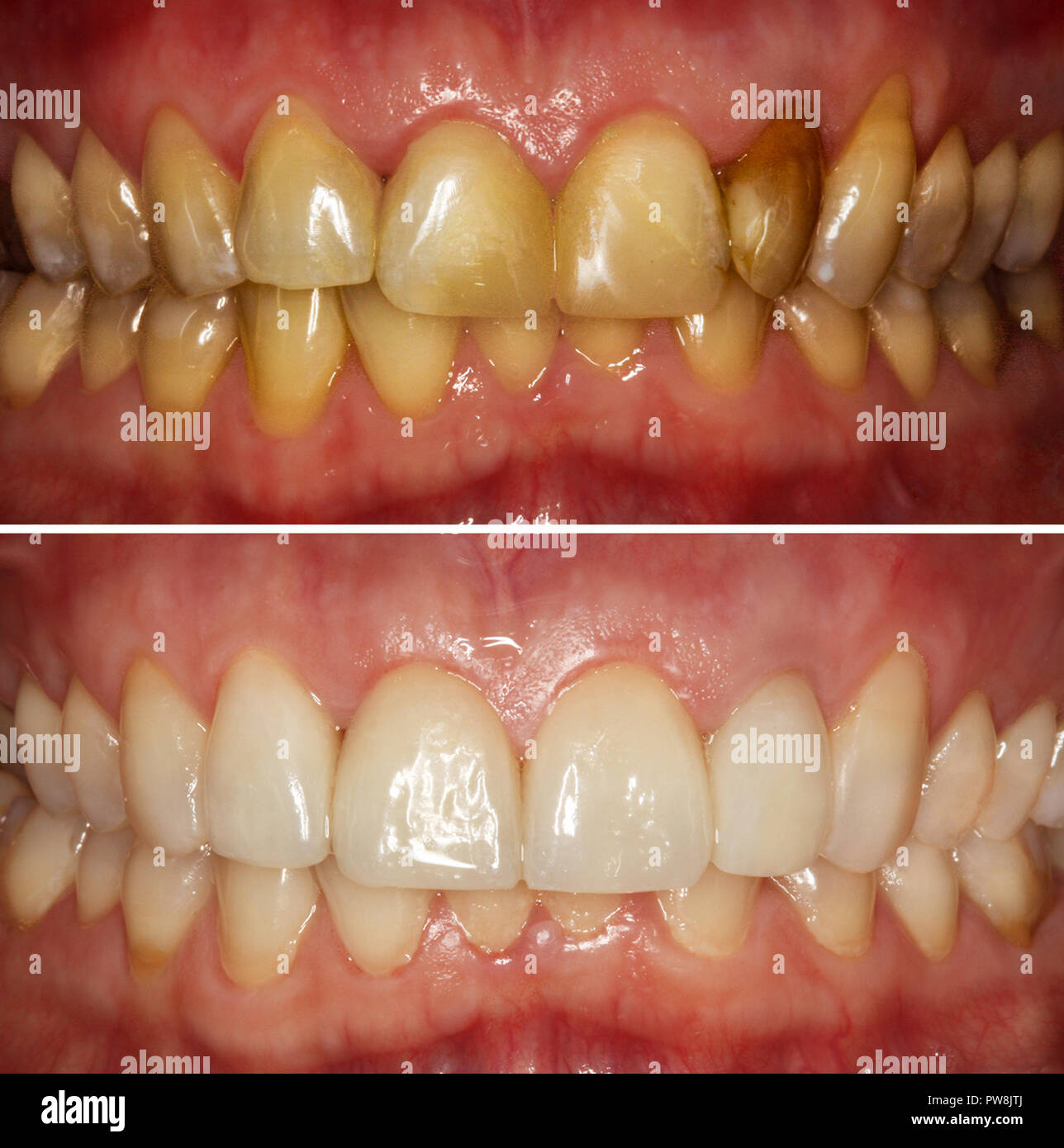 Frontal teeth before and after restoration. Big Smile Stock Photo - Alamy