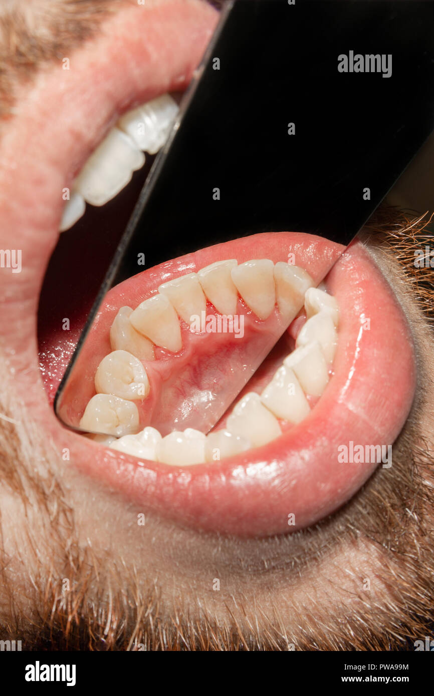 tartar close-up on the lower anterior incisors. Dental hygiene of teeth ...