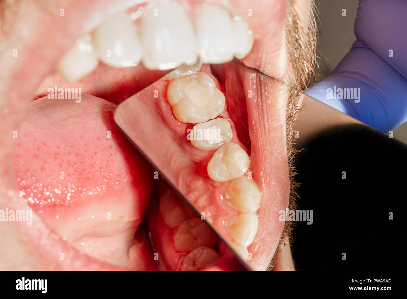 endodontic treatment of teeth close-up. Cleaning of the roots of the ...